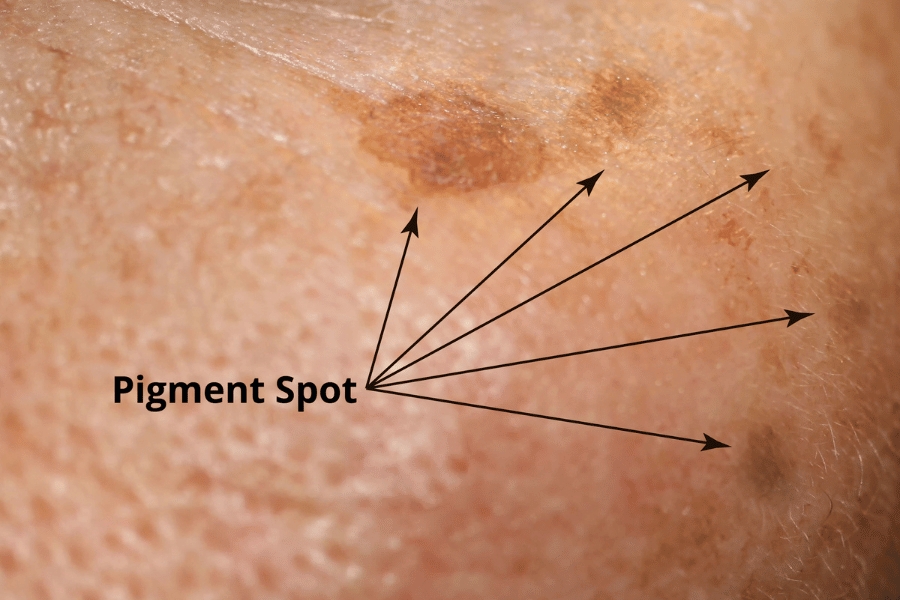 Melasma vs Hyperpigmentation: Differences & Treatments | Elite Selects